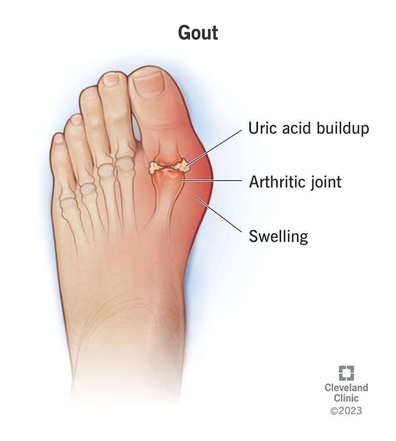 Understanding Uric Acid, Gout, and Uric Acid Diathesis
